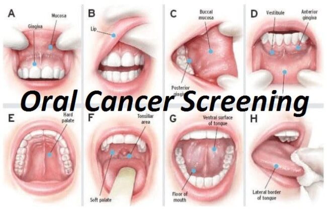 Oral Cancer Screening – Main Street Dentalin